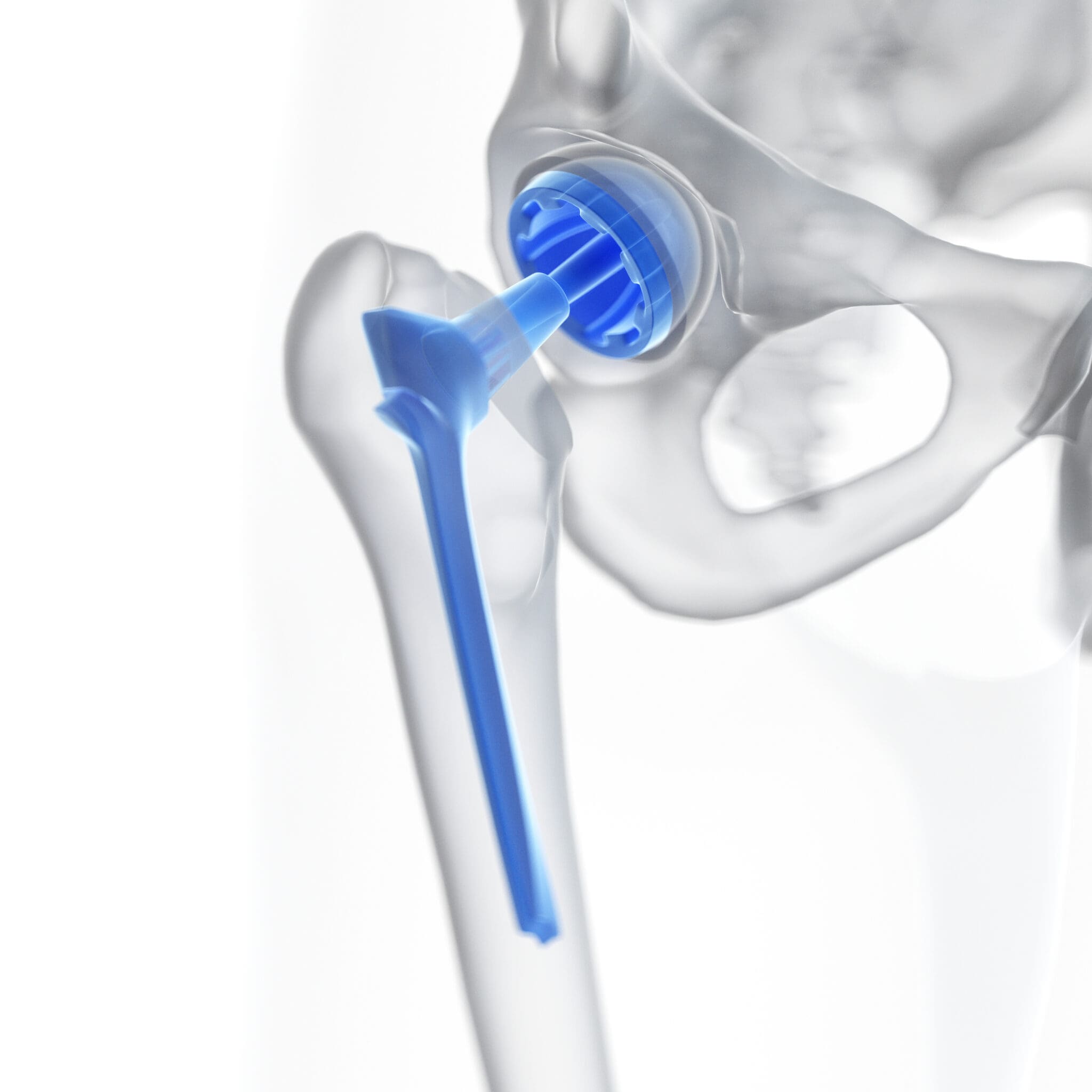 Kinesiology THURSDAY- Total Hip Replacement – Movewell Academy