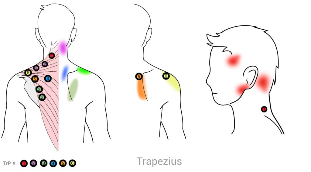 Kinesiology THURSDAY – What’s the big deal about Trigger Points ...